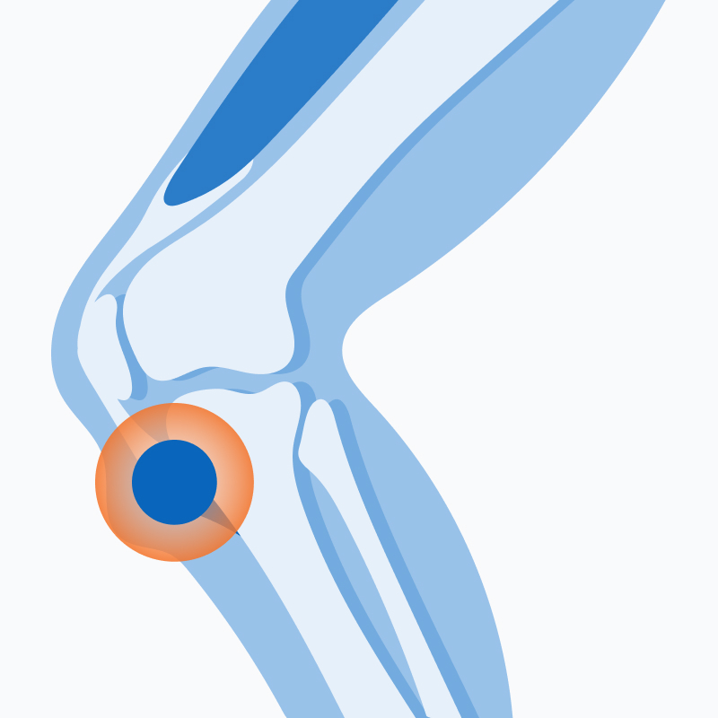 Knee ACL Protocol Phase 1